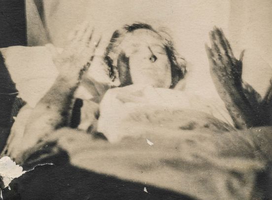 1725 Dublin children received the first smallpox vaccination